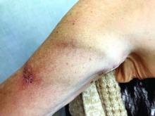 Upper arm loop grafts - Vascular Specialist