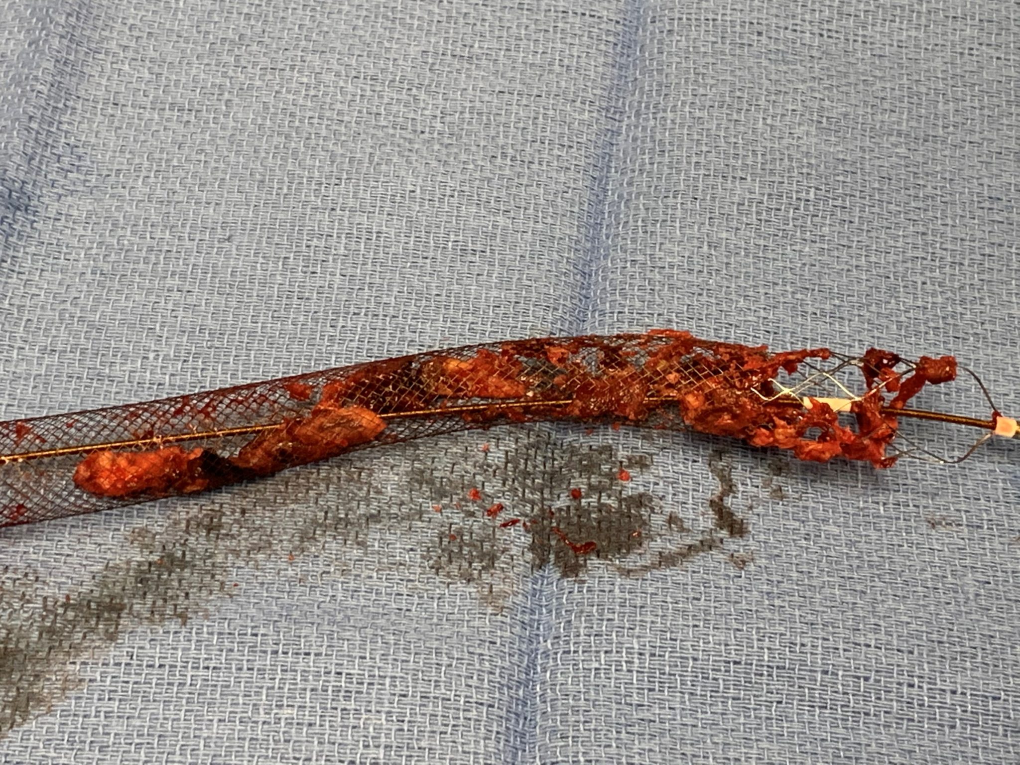 Registry data show greater clot chronicity on post-procedure inspection ...