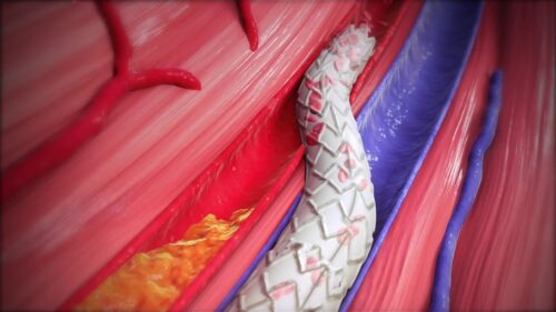 FDA approves LimFlow system for 'no-option' CLTI patients - Vascular ...