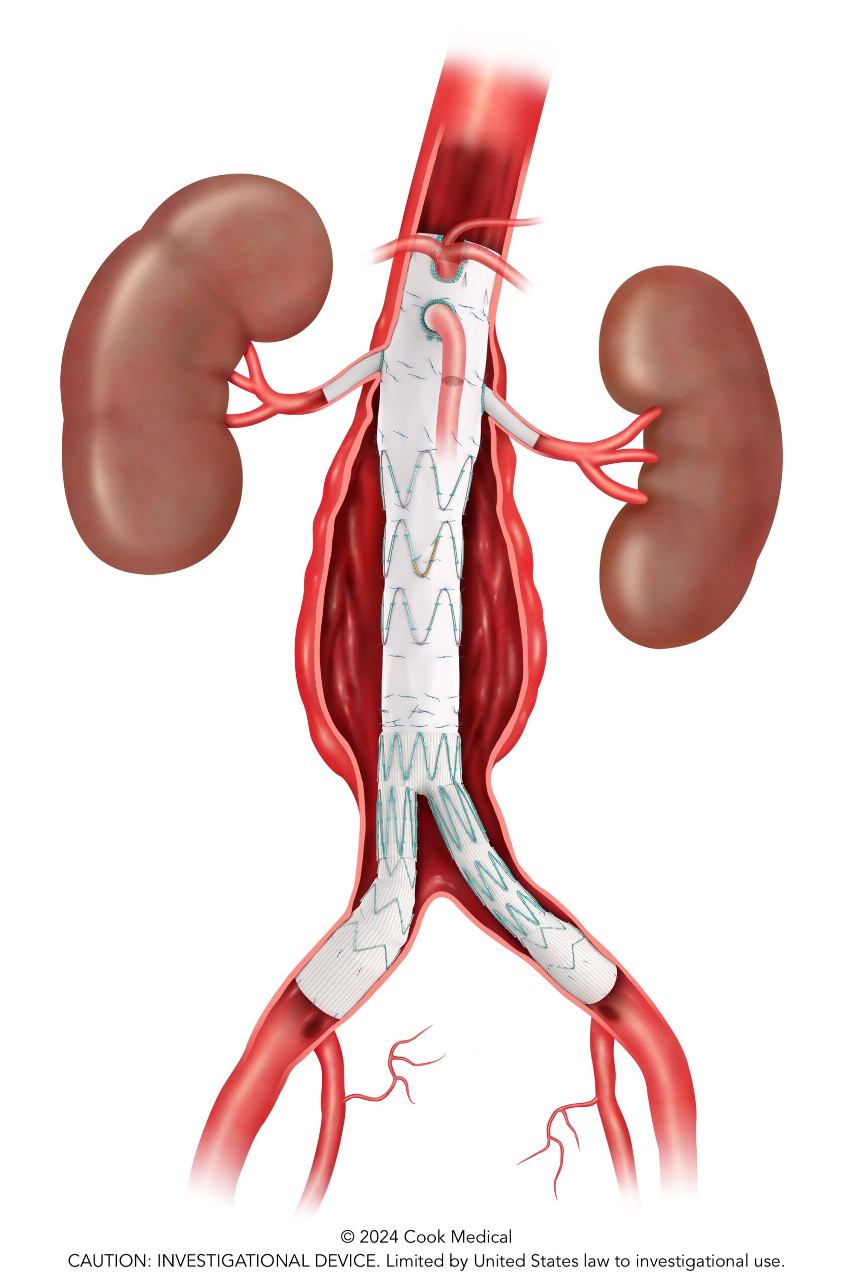 First patient treated in ZFEN+ fenestrated endovascular graft study ...