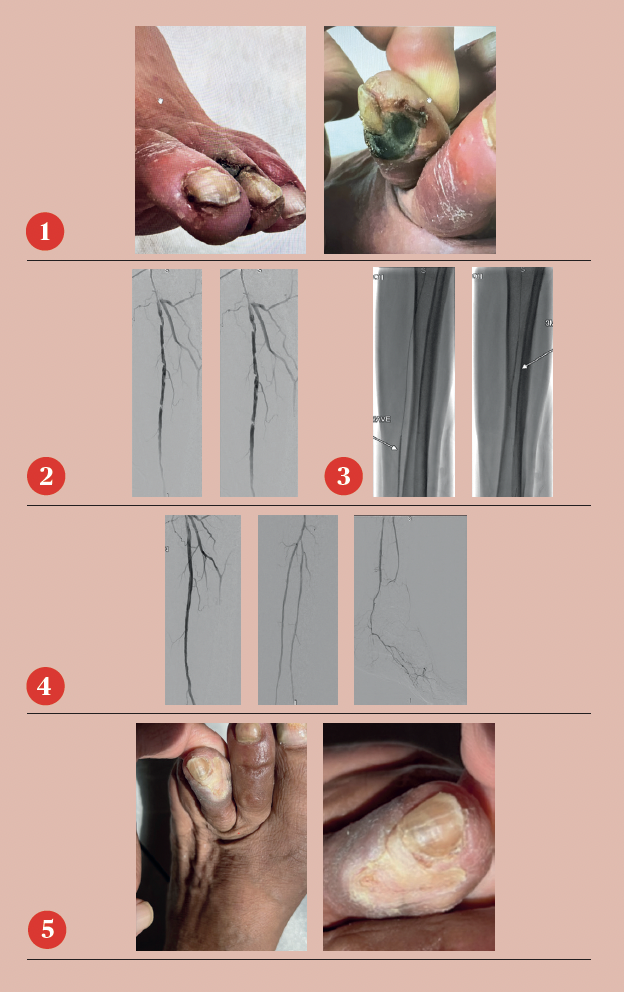 The Shockwave E8 experience: Featuring the new Shockwave peripheral IVL ...
